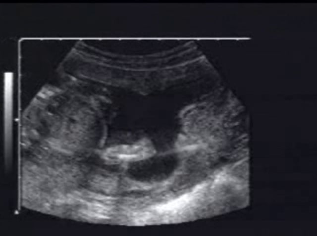 Radial ray defects – ULTRASOUNDPAEDIA