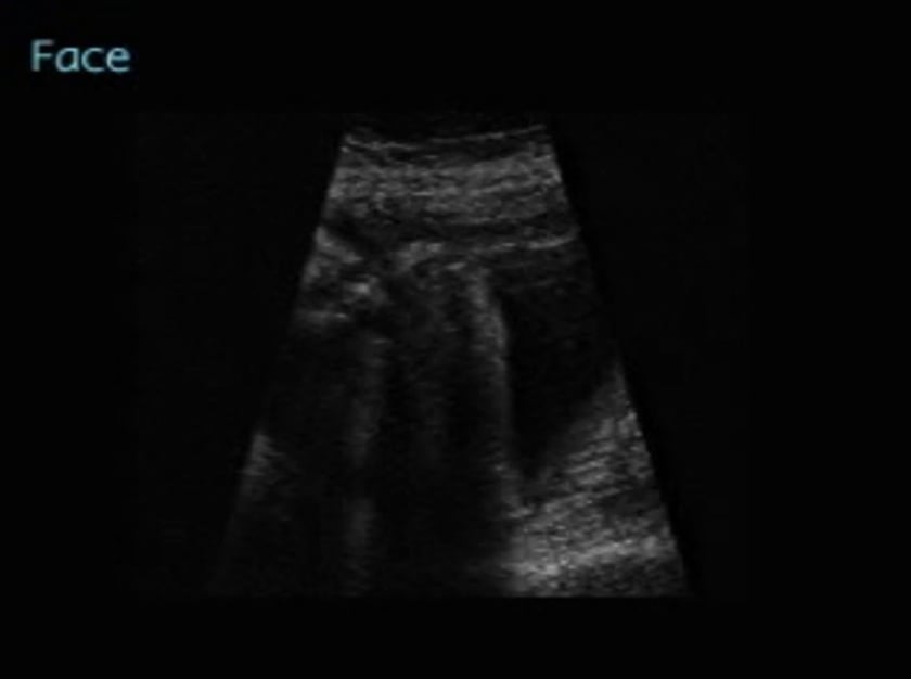 Robinow syndrome – ULTRASOUNDPAEDIA