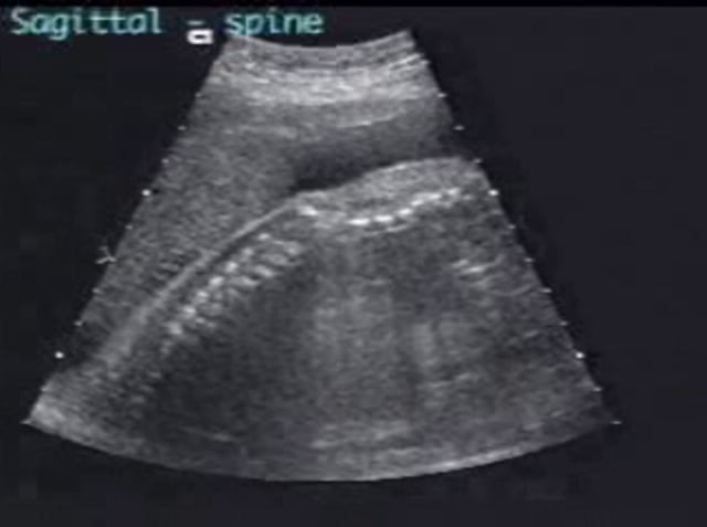 Caudal regression syndrome – ULTRASOUNDPAEDIA
