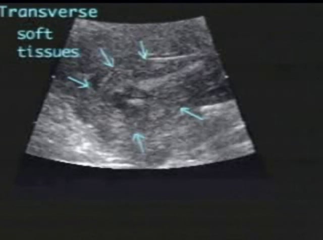Caudal regression syndrome – ULTRASOUNDPAEDIA