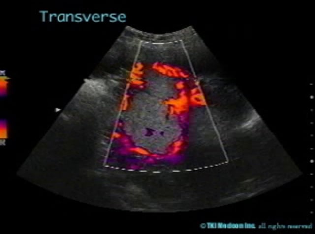 Placenta accreta – ULTRASOUNDPAEDIA