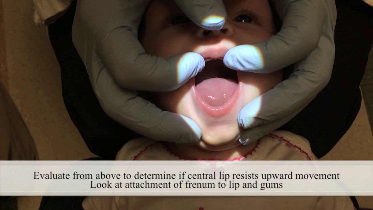 Examination Technique For Tongue-Tie and Lip-Tie