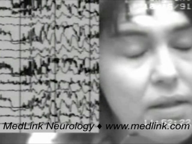 Eyelid myoclonia with absences (video-EEG) | MedLink Neurology