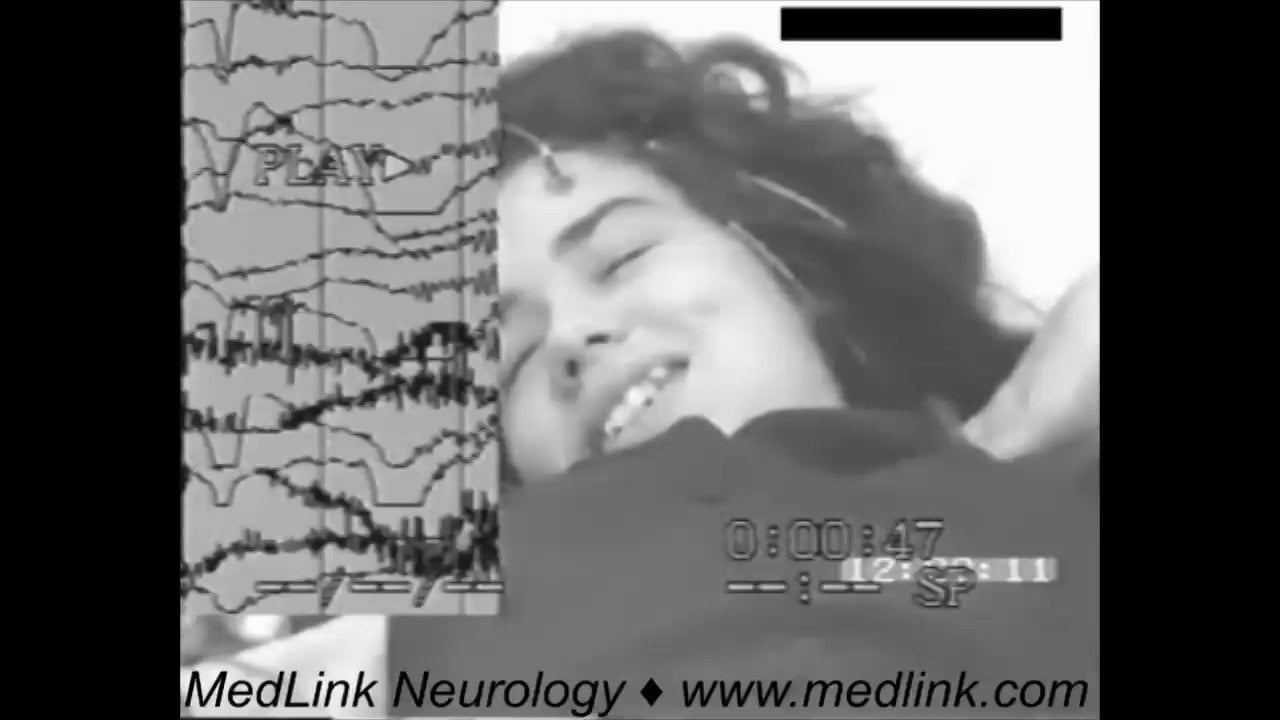 Visual-sensitive epilepsies | MedLink Neurology