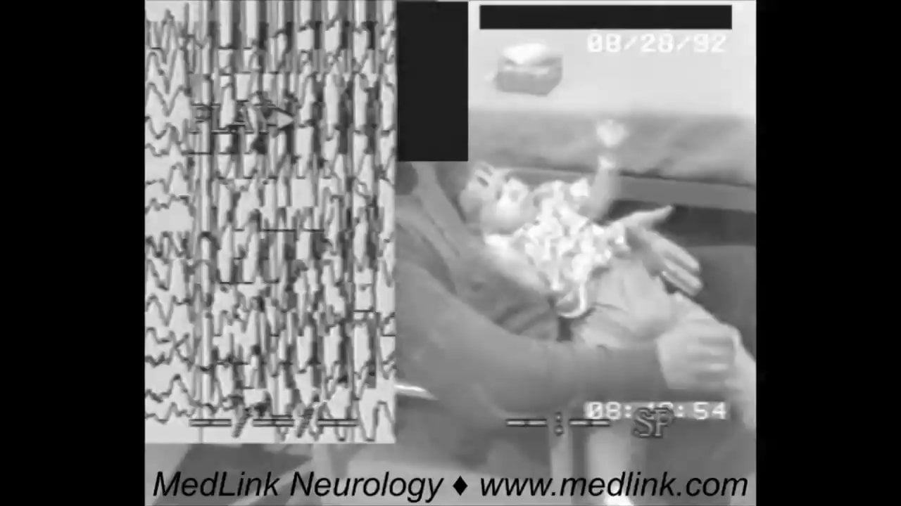 Generalized onset clonic seizures | MedLink Neurology