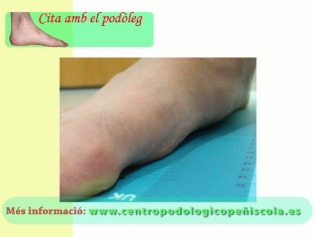 VALORACIÓN DEL RETROPIÉ EN CARGA in Podología on Vimeo