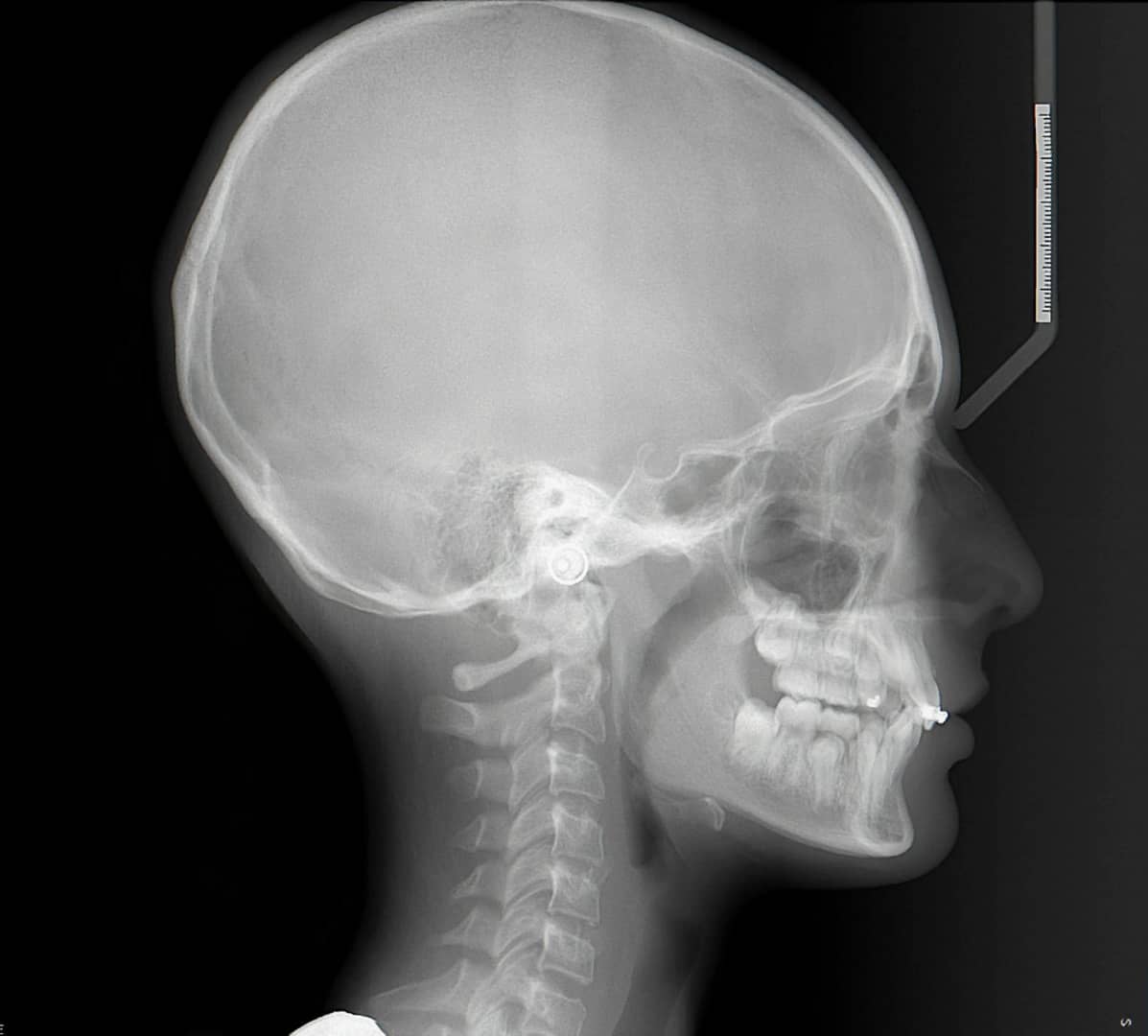 Overbite: Orthodontic Treatment of a Patient with an Overbite (Xray) on ...