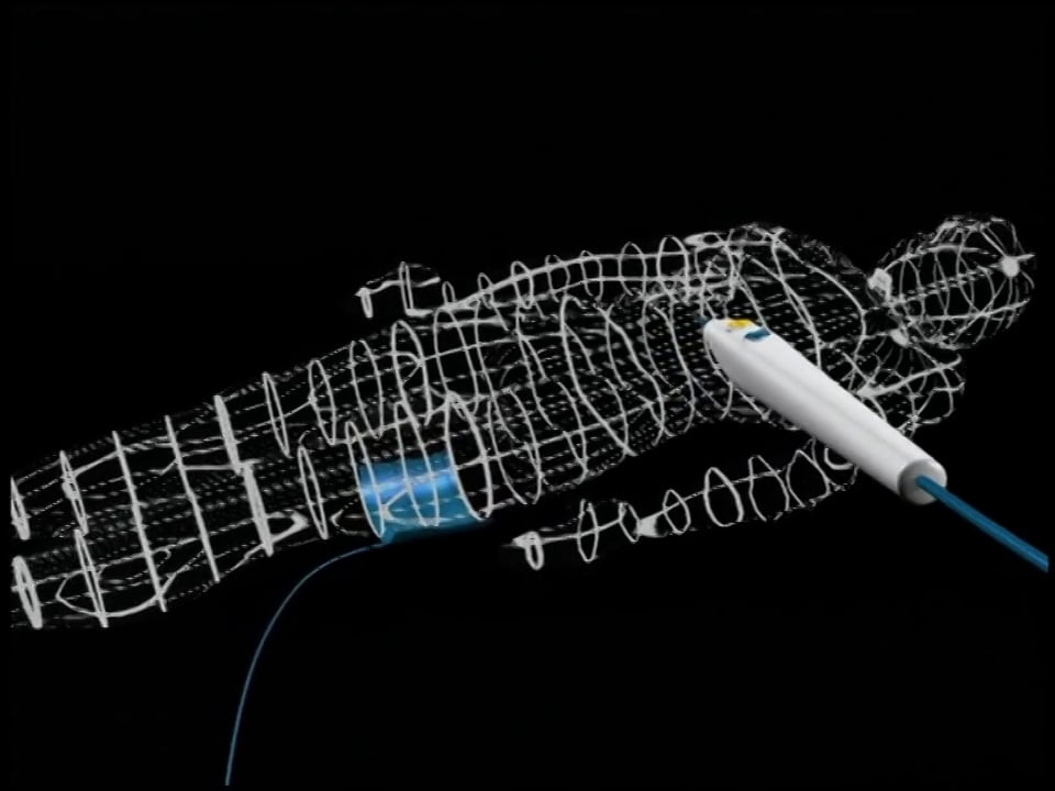 Demo Reel - Ethicon Power Star Bipolar Scissors Marketing Video on Vimeo