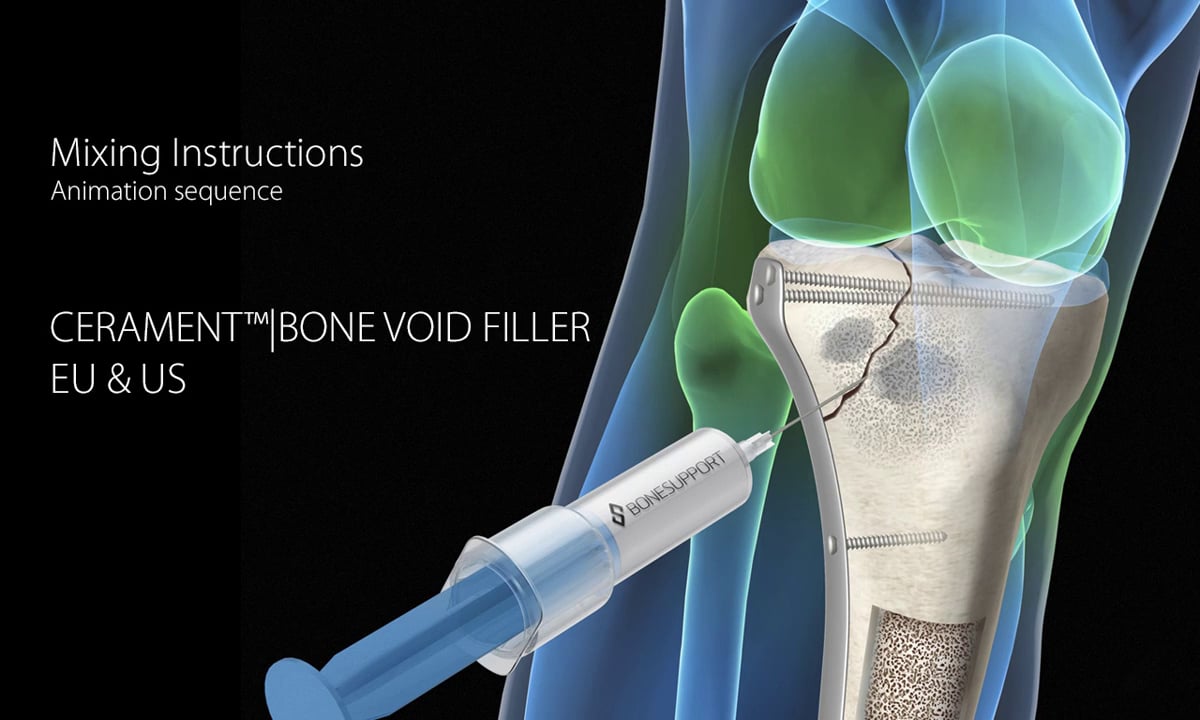 Cerament(TM) Bone Void Filler - Mixing Instructions on Vimeo