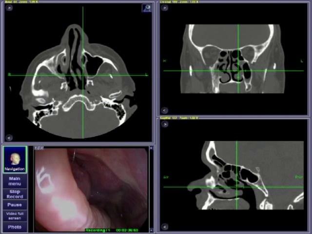 Sinusotomie frontale sphénoidotomie on Vimeo