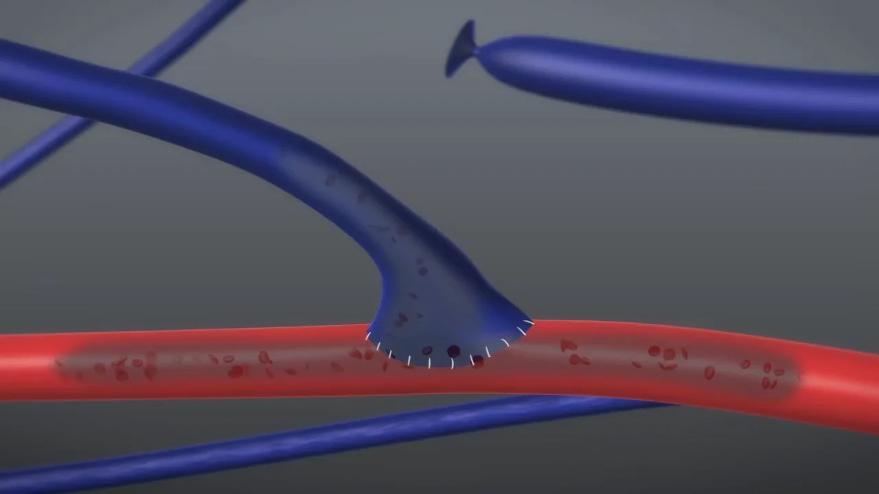 Gefaesschirurgie - Cimino Shunt - DE