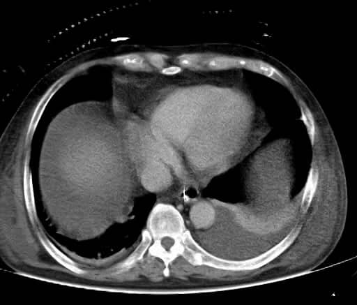 Bilateral subphrenic abscesses (serial CT images) on Vimeo