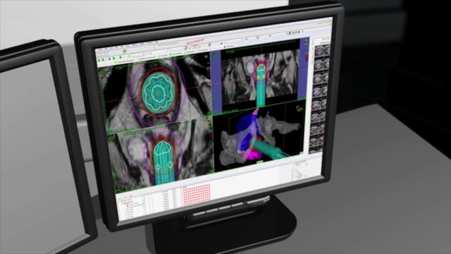 Elekta Brachytherapy on Vimeo