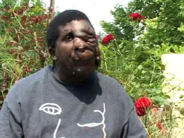 Meet Reggie Bibbs & neurofibromatosis