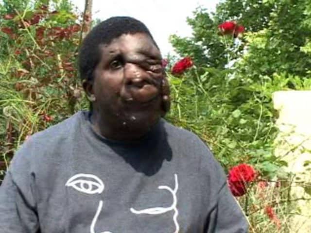 Meet Reggie Bibbs & neurofibromatosis on Vimeo