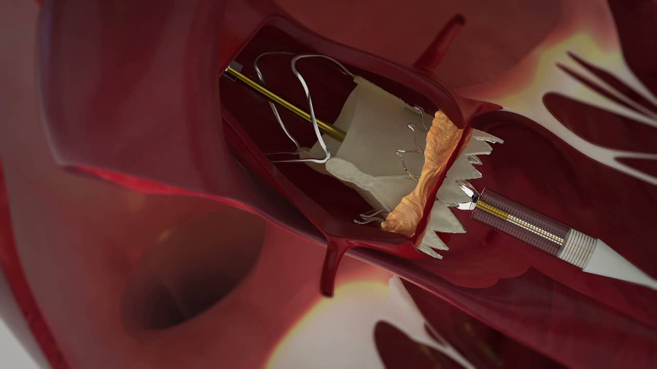 SYMETIS ACURATE neo transfemoral TAVI system on Vimeo