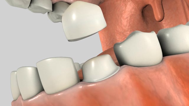 Crowns | Dentistry in Boca Raton | Polin Dental