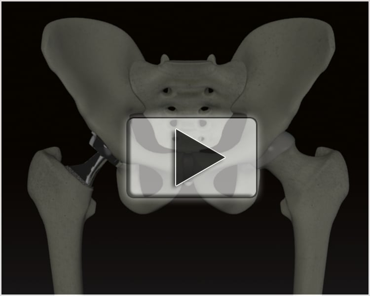 Metal-on-Metal Hip Replacement Recall - Volume 1: Ions (MVI1101) on Vimeo