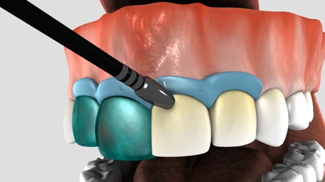 Professional Teeth Whitening Services in Memphis