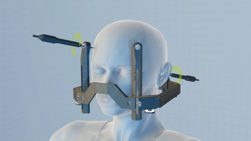 Leksell Stereotactic G Frame on Vimeo