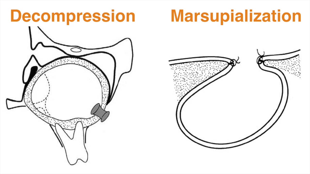 Decompression or Marsupialization Technique for Managing Large ...