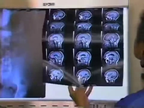 The morgan lens for eye irrigation on Vimeo