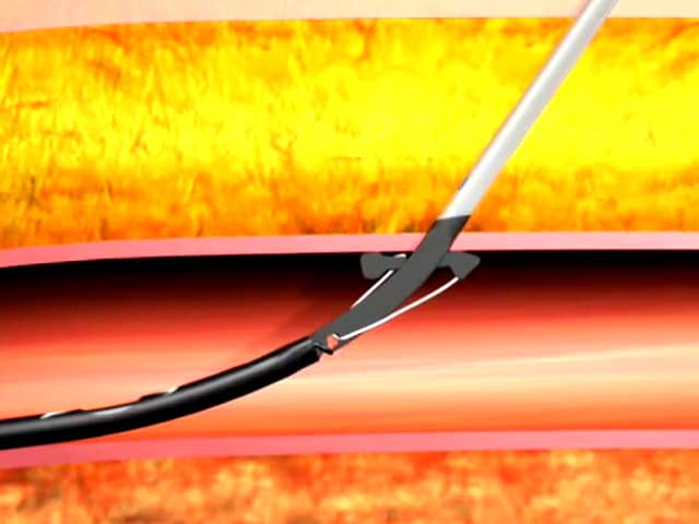 Perclose Device Deployment on Vimeo