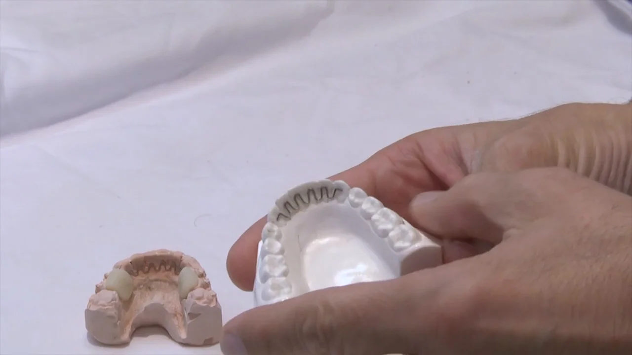 The V-Loop Retainer - V-Loop Retainer on Vimeo