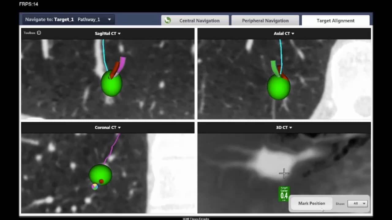 Navigation Bronchoscopy with superDimension Version 7.0 on Vimeo