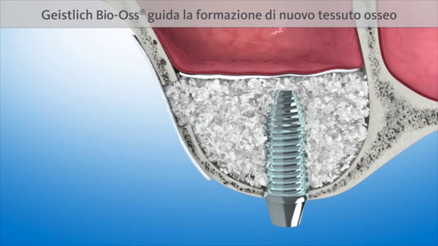 Rialzo di Seno – Studio dentistico Mora Legnago (Verona) – Studio ... Rialzo di Seno – Studio dentistico Mora Legnago (Verona) – Studio ...