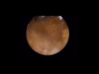 HoLEP Morcellation, Courtesy of Lori Lerner, MD on Vimeo