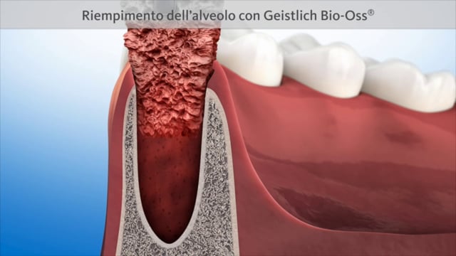 Socket preservation – Studio dentistico Mora Legnago (Verona) – Studio ... Socket preservation – Studio dentistico Mora Legnago (Verona) – Studio ...