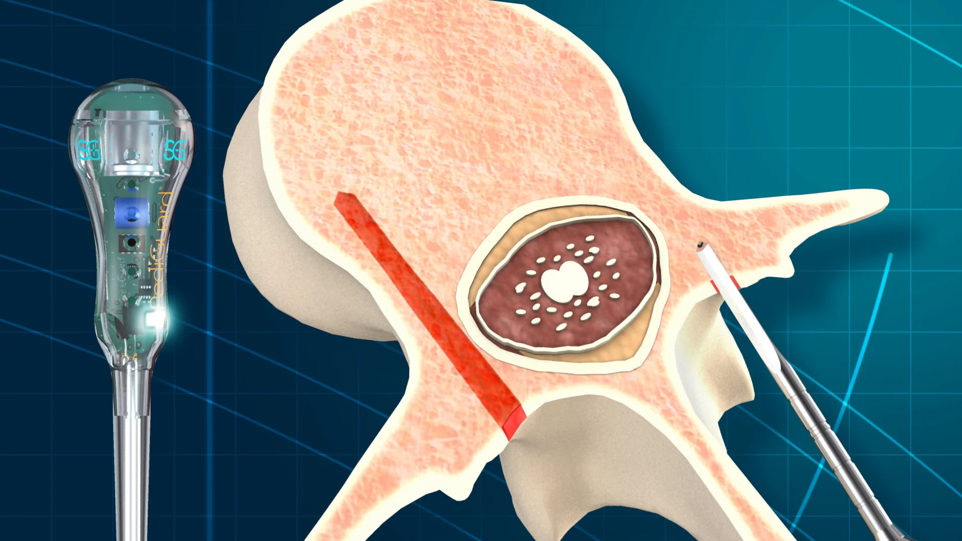 SpineGuard: Classic PediGuard Animation on Vimeo