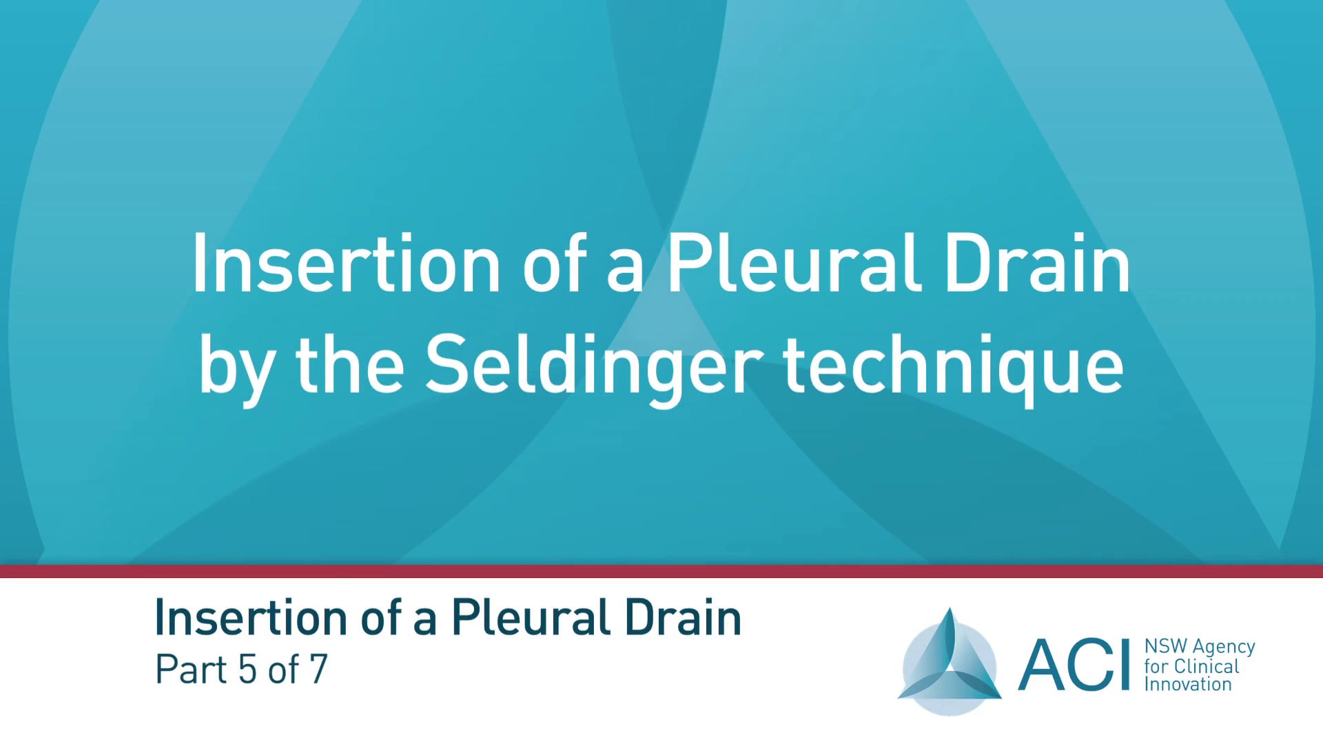 Insertion of a pleural drain by the Seldinger technique on Vimeo