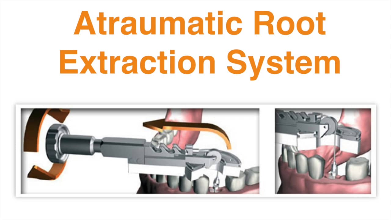 Atraumatic and Non-Invasive Root Extraction Technique on Vimeo