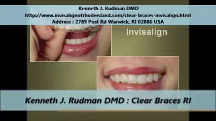 Kenneth J. Rudman DMD Invisible Braces RI on Vimeo