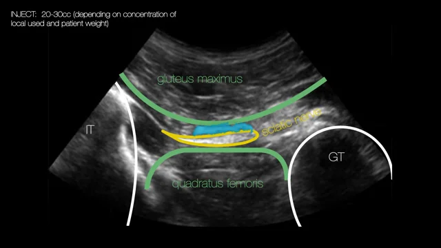 Subgluteal Block on Vimeo