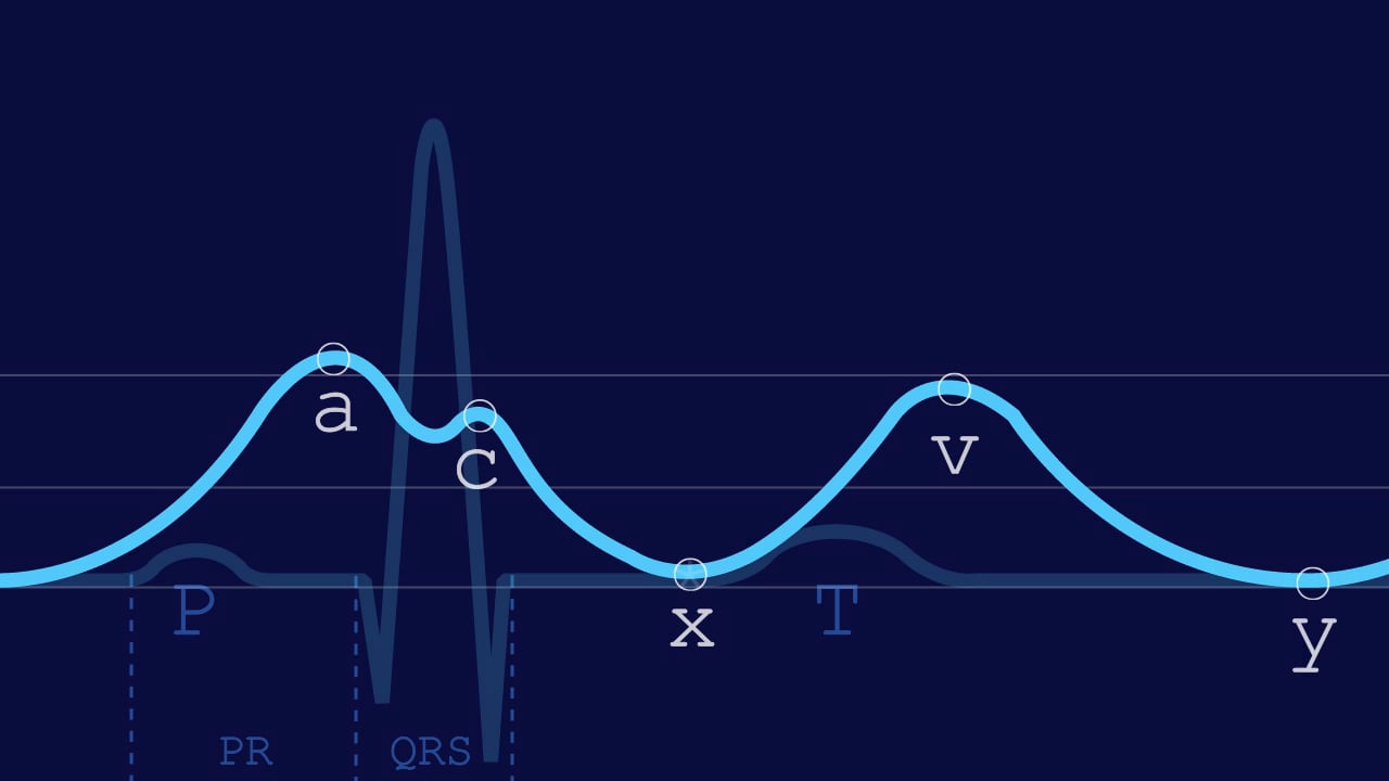 Understanding Central Venous Pressure Waveforms on Vimeo
