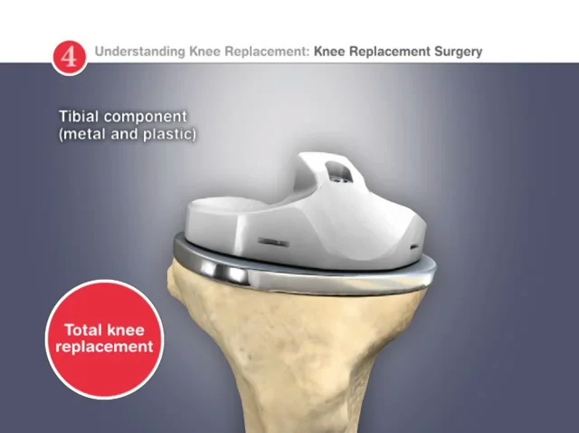 knee replacement animation on Vimeo