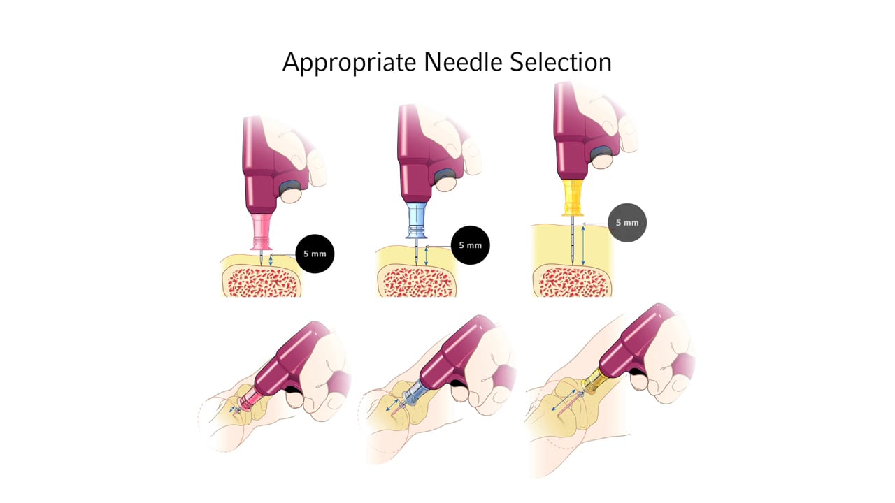 EZ-IO - Infant/Child Needle Selection and Insertion Technique Animation ...