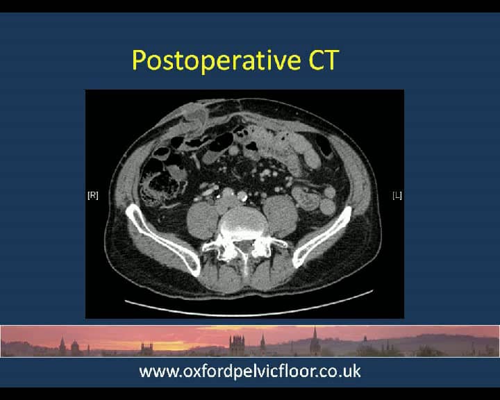 Laparoscopic Modified Sugarbaker Technique for the Repair of an ...