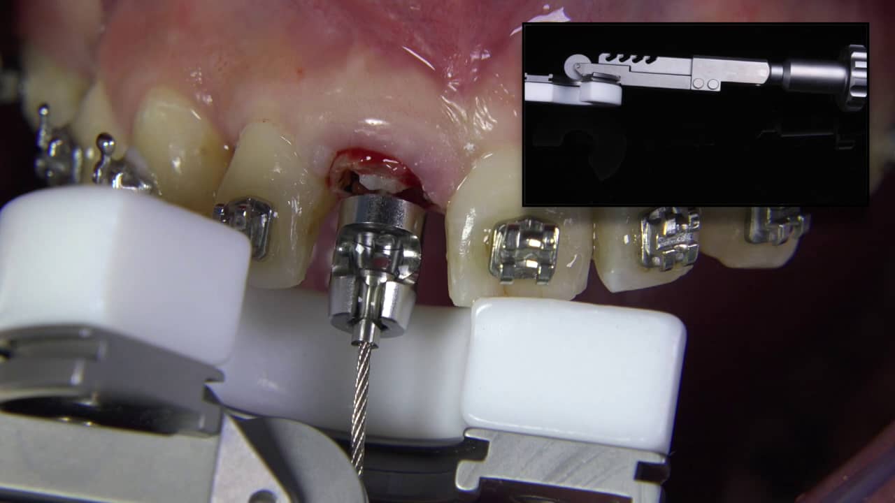 Minimally traumatic extraction with " NEW BENEX II " - IMPLANTEPERIO ...