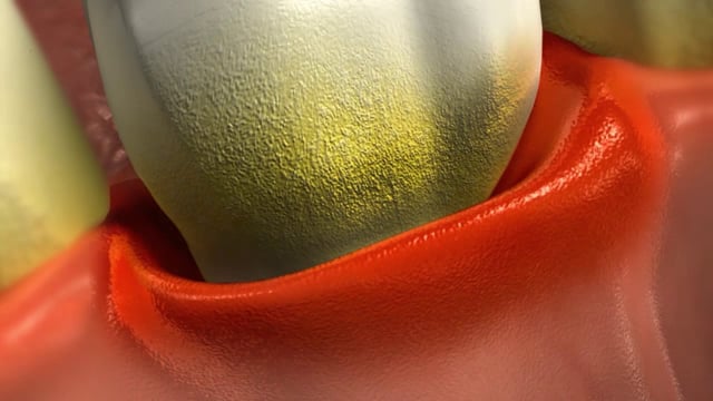 Top Gum Disease Treatment in Sacramento | Mark A Kujiraoka DDS