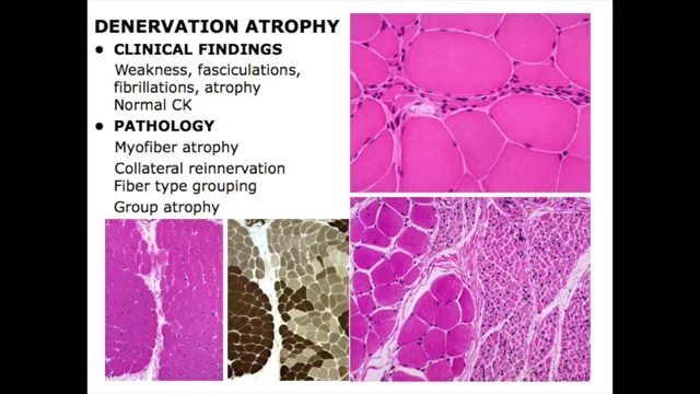 Muscle Atrophy Histology
