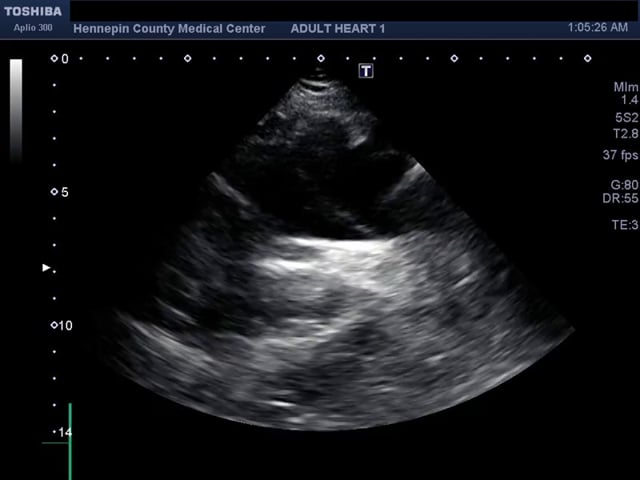 Suprasternal Notch Echo