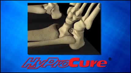 Minimally Invasive Foot Surgery & HyProCure Stent - Beverly Hills, Los ...