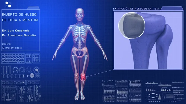 Injerto de hueso de tibia a mentón on Vimeo