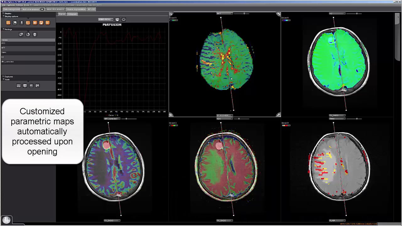 VPMC-13620A Olea Sphere Tumor on Vimeo