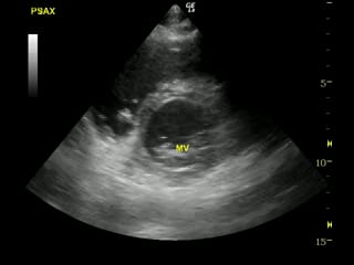 Mitral valve - MV normal PSAX Bowra on Vimeo