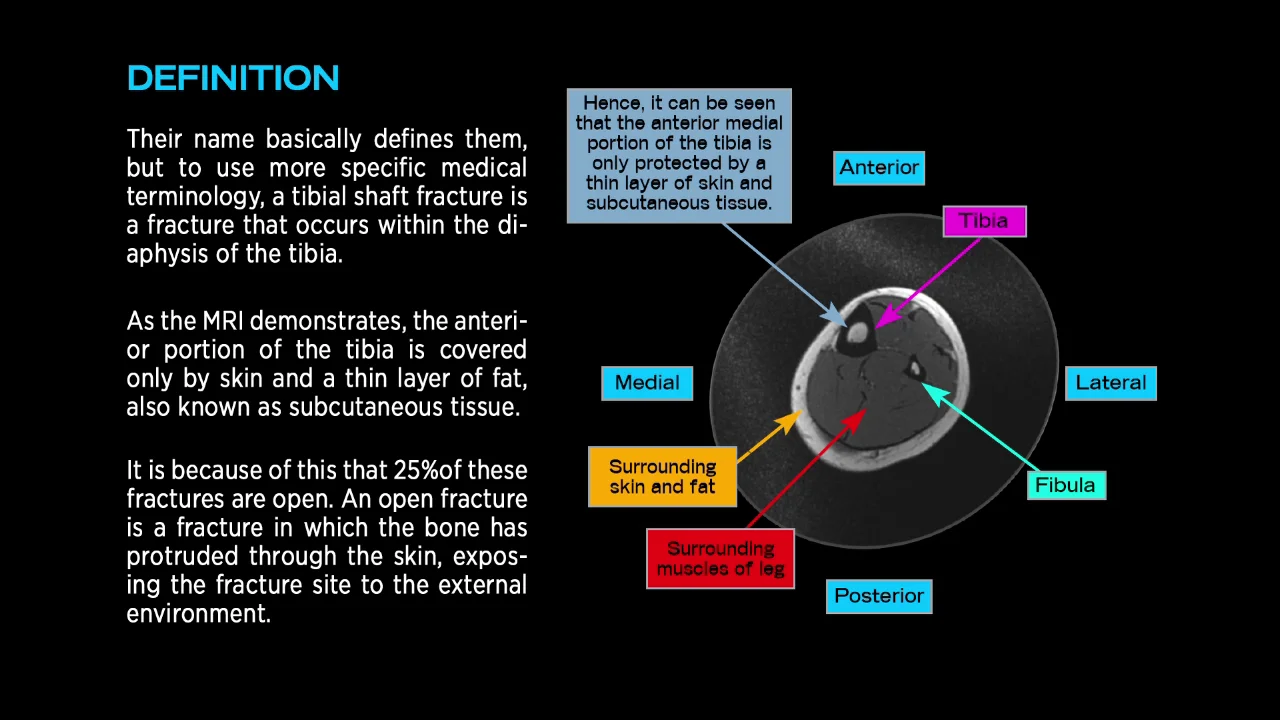 Fracture Central Education / Inspiration - Tibial Shaft Fractures ...